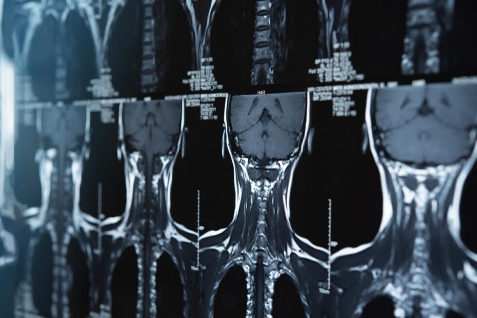Do You Really Need That Scan? - Brisbane Headache & Migraine Clinic